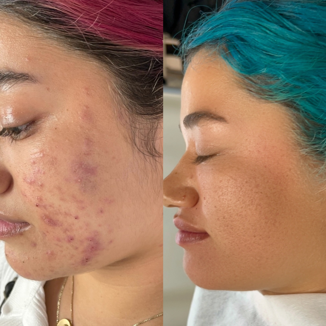 Acnea: problem skin, solved